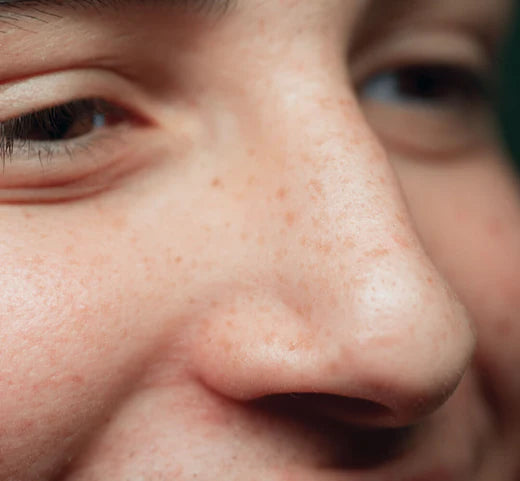 Understanding Sebaceous Filaments – Vue Swiss US