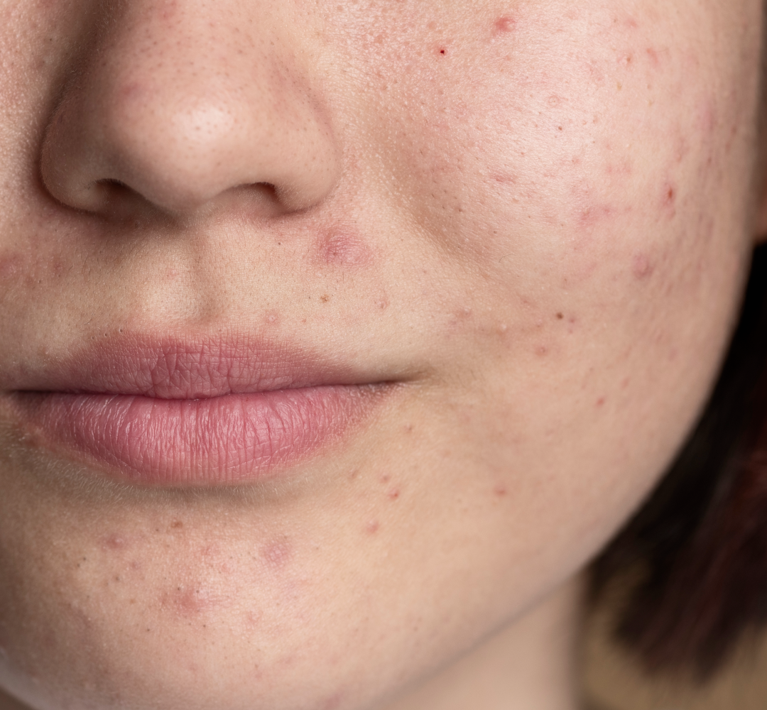 Acne Explained: What’s Happening Under Your Skin? – Vue Swiss US