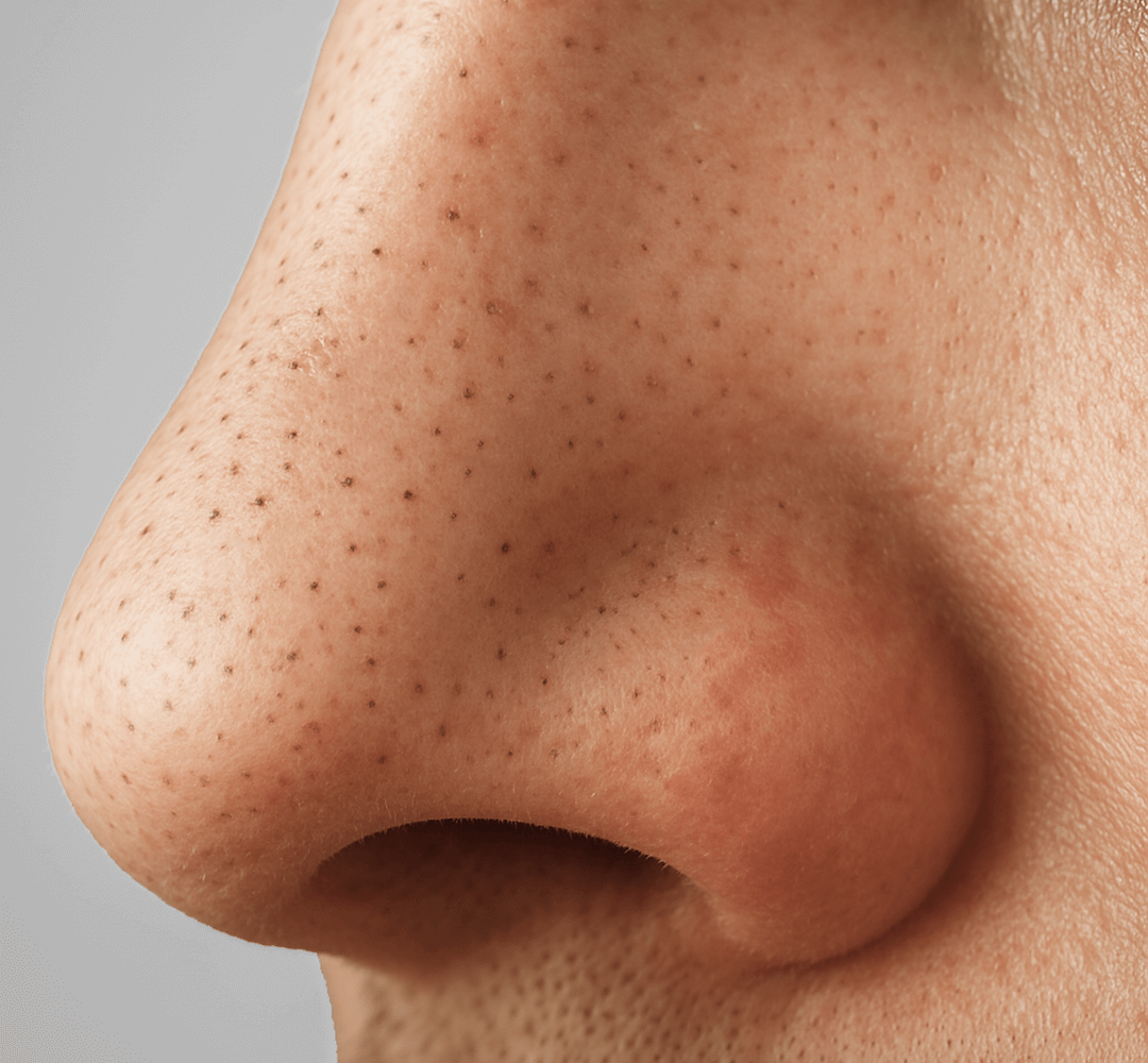 The Blackhead Lifecycle: How They Form, Live, and (Finally) Die – Vue ...